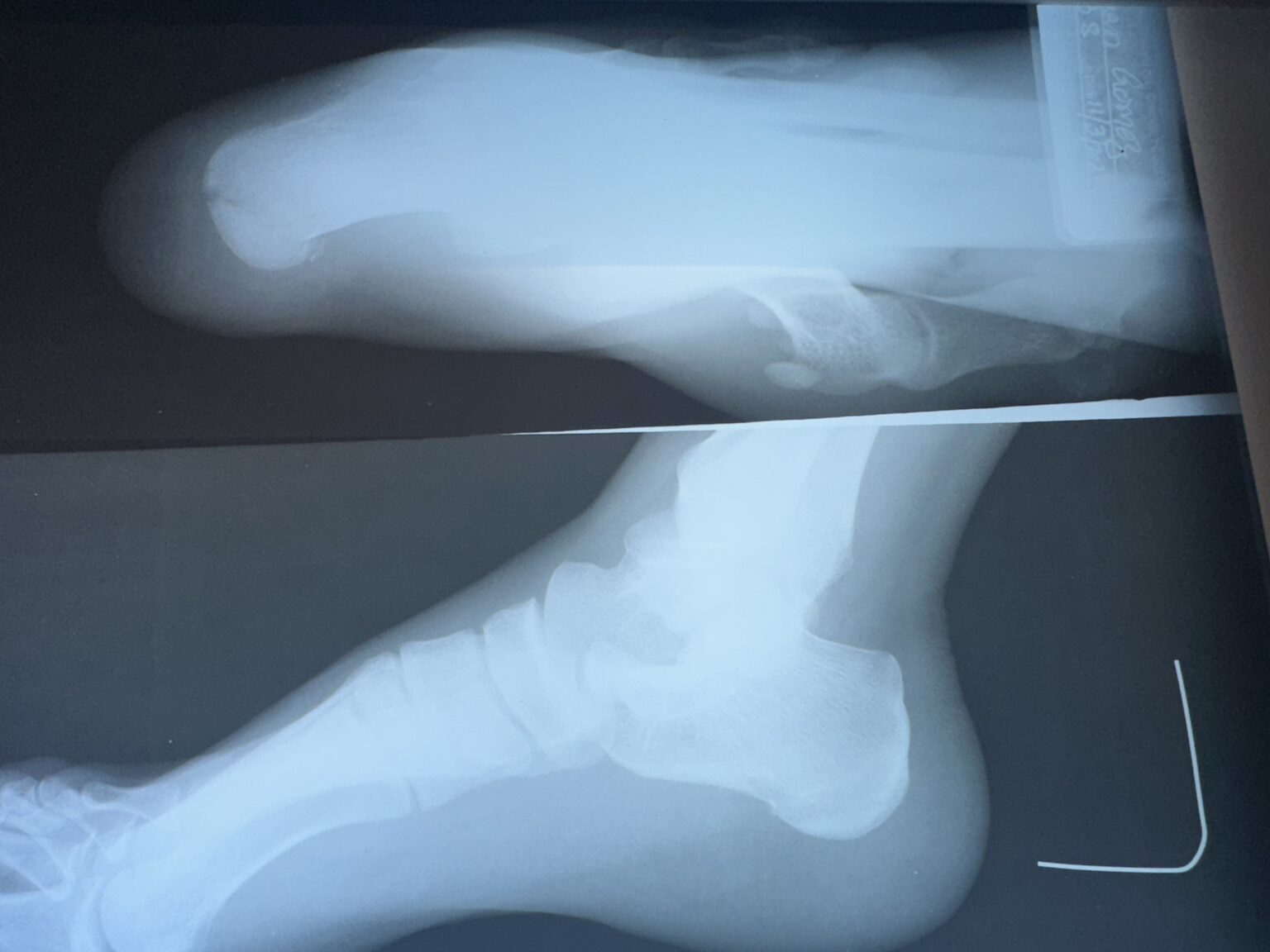 Fracture of Heel of Foot from fall from Height Urgent Care Orlando ...